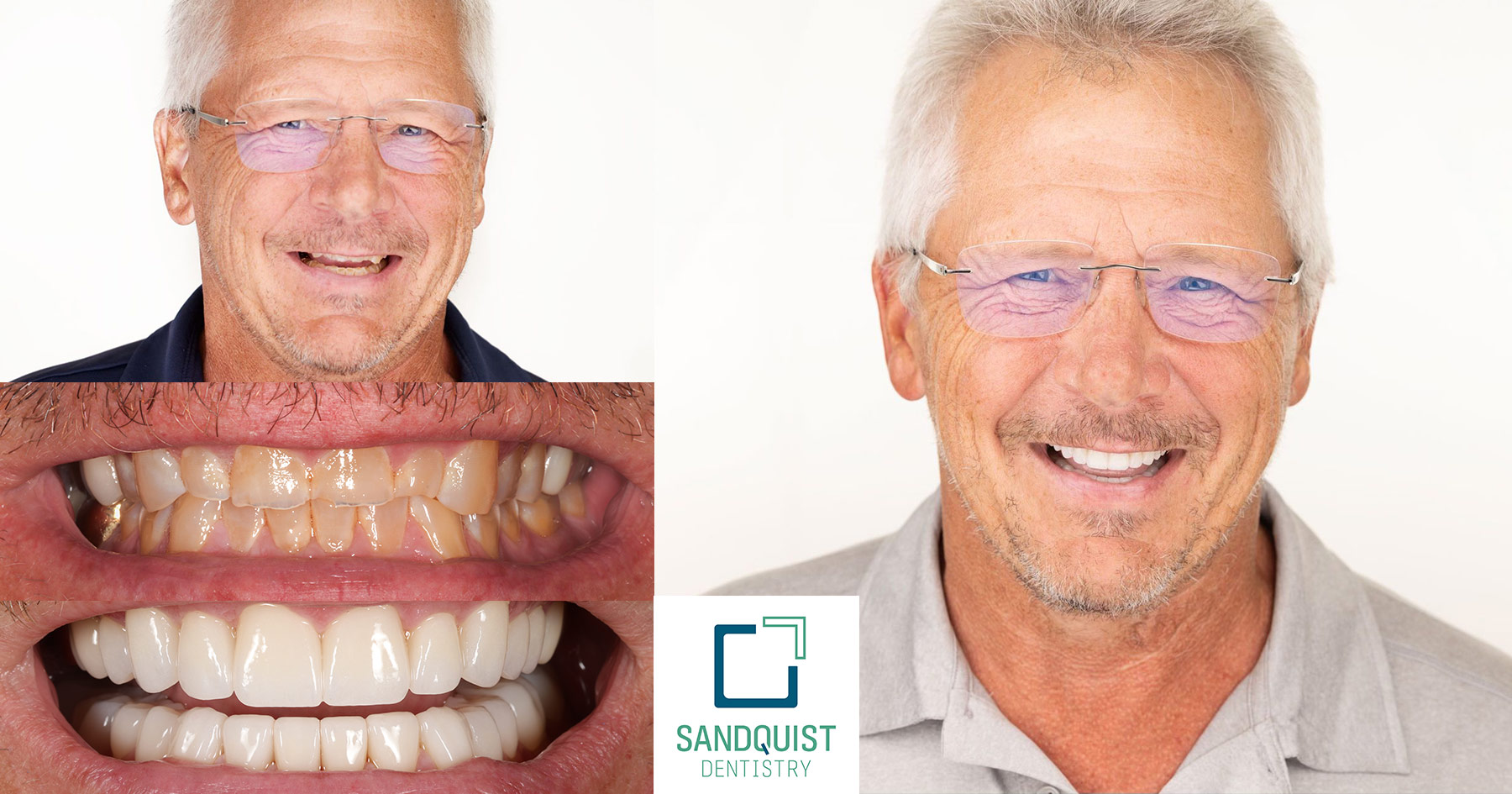 New Smile For Pat - Sandquist Dentistry - Las Vegas Dentist