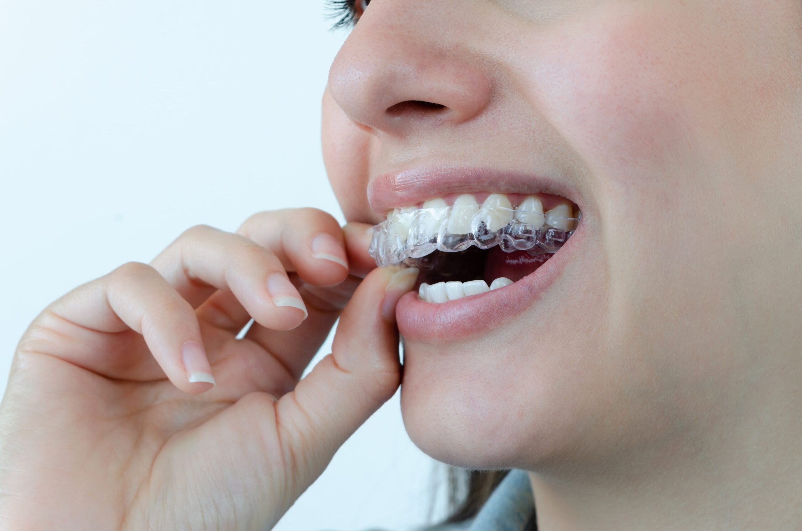 How Does Invisalign Work? A Complete Guide for Las Vegas Patients